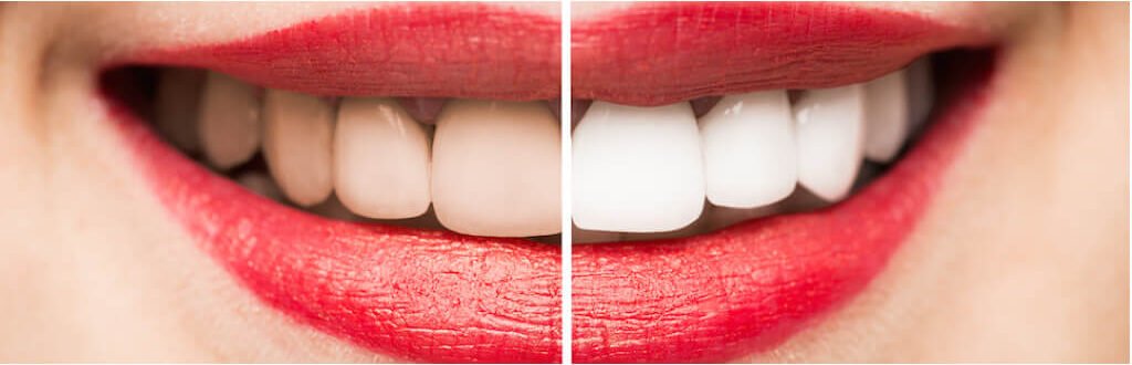 Glorysmile | High Quality Teeth Whitening Products